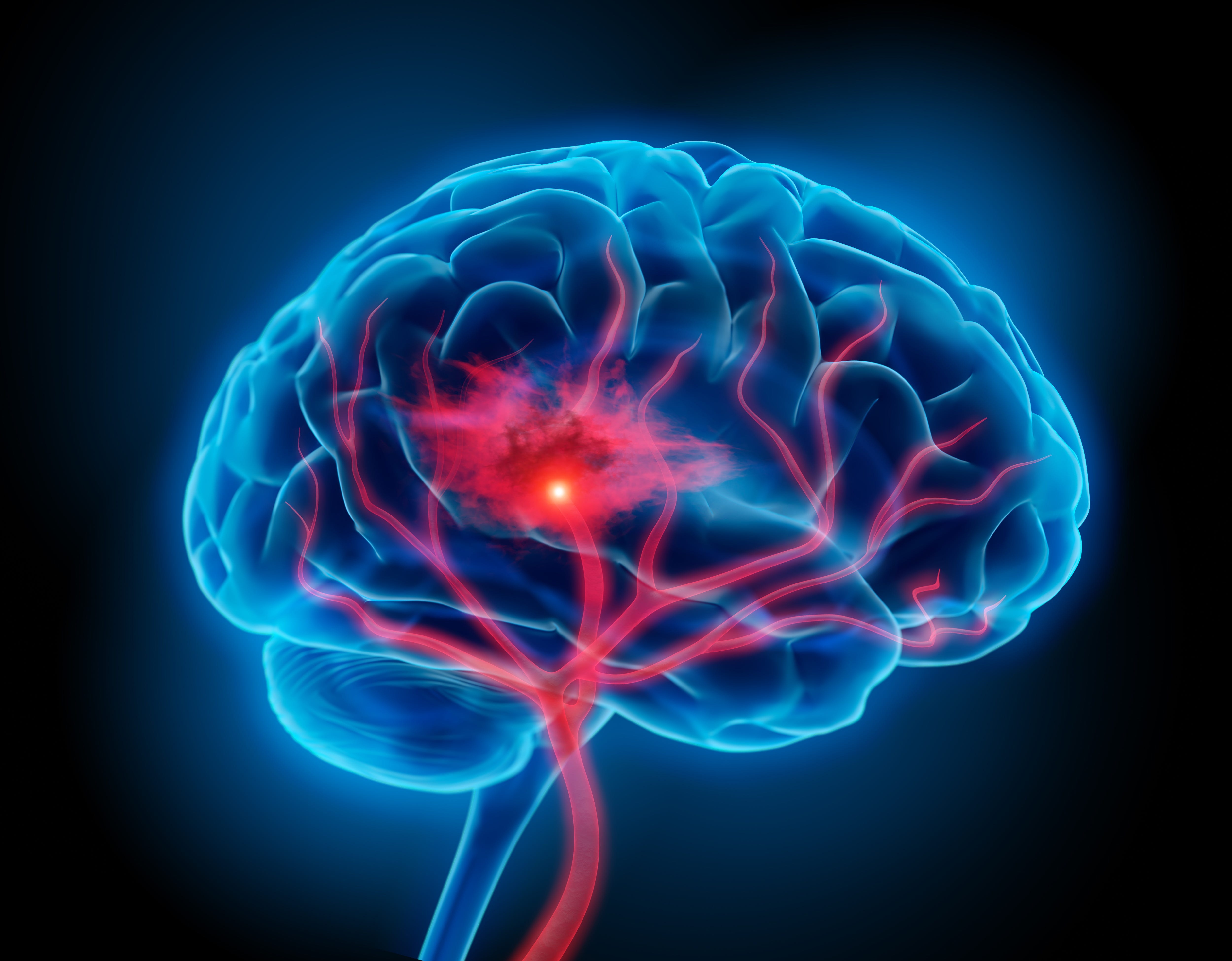 Tenecteplase for acute ischemic stroke presenting after 4.5 hours ...