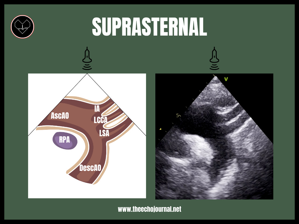 Subcostal and Suprasternal: Underrated but Essential