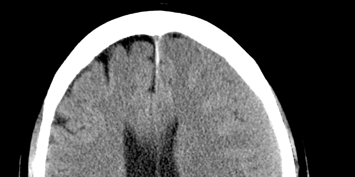 Subacute and chronic subdural hematoma