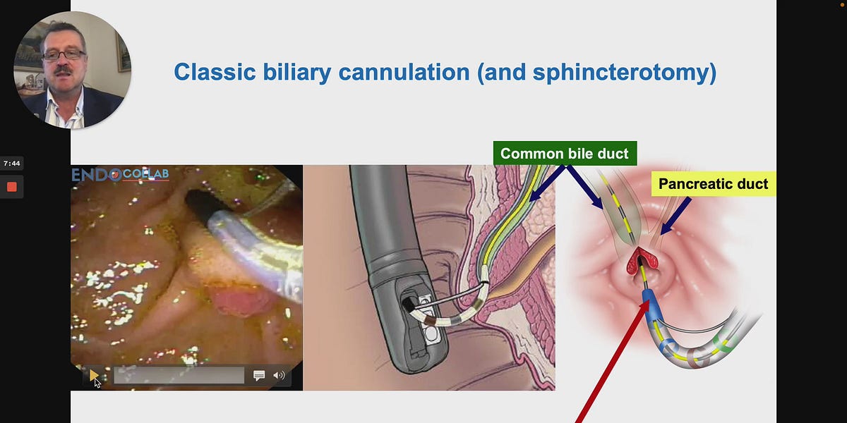 ercp procedure nbm
