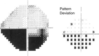 Altitudinal visual field defect – assessment and clinical significance