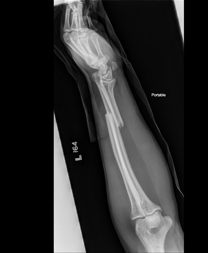 Forearm fractures - by Alexander Baxter - RadNotes