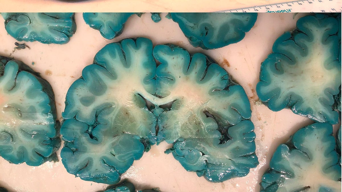 The Blue Brain Effect: Methylene Blue’s Dark Side & What You Should Be ...