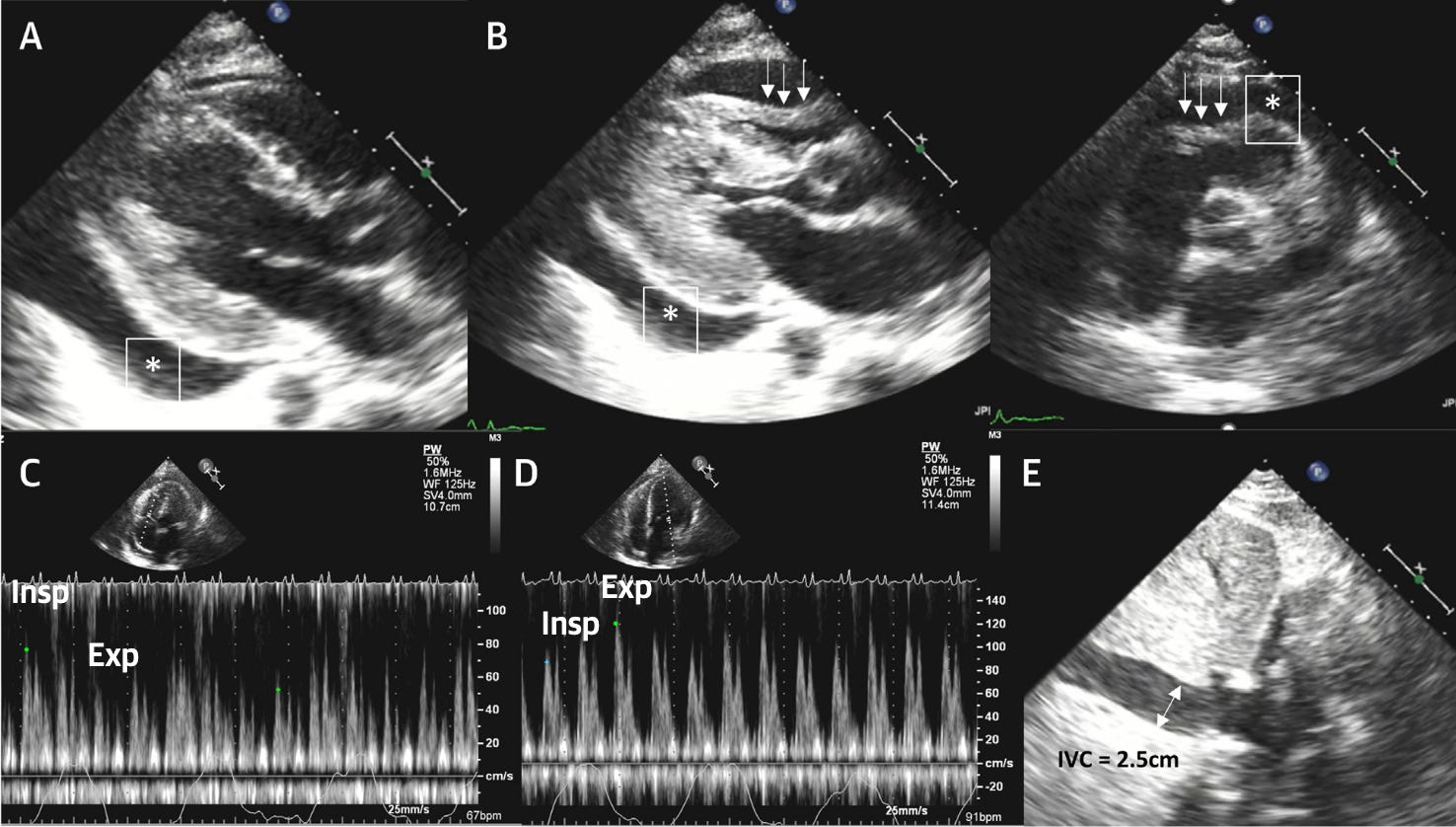Manejo do Derrame Pericárdico