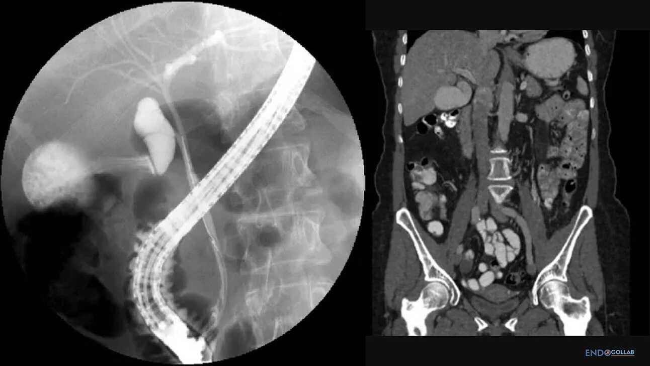 What is a Phrygian (Cap) Gallbladder? - EndoCollab