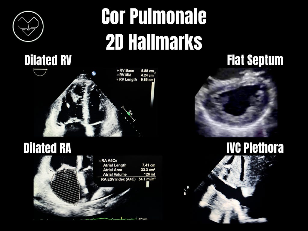 Cor Pulmonale on Echo: What Sonographers Need to Know