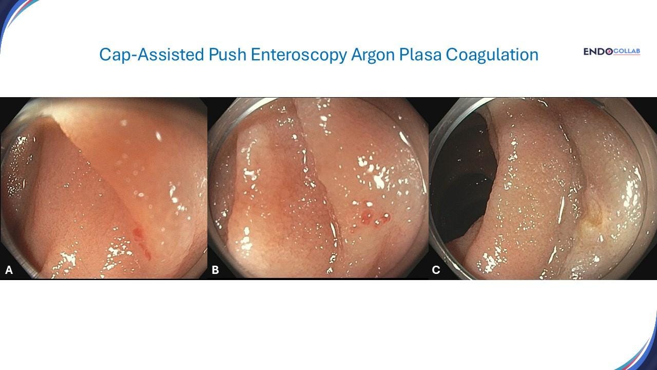 Cap-Assisted Push Enteroscopy Argon Plasma Coagulation - EndoCollab