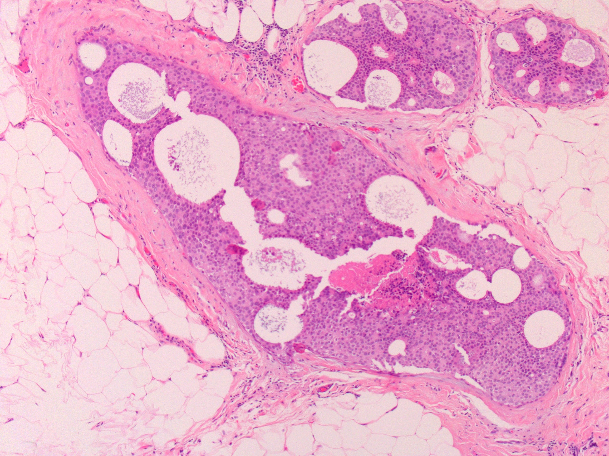 Ductal Carcinoma in Situ (DCIS) - by Chelsea Mehr, MD