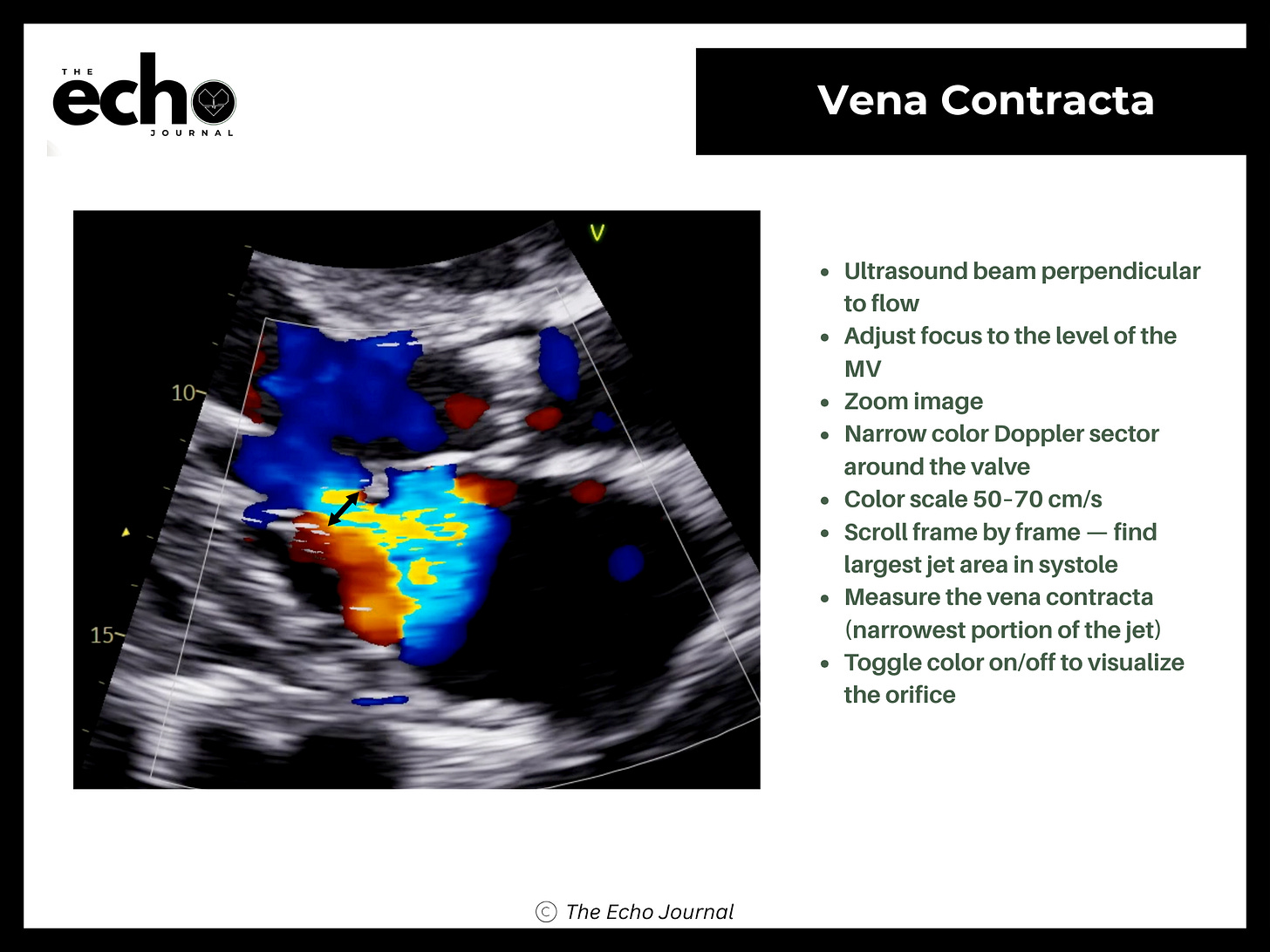 Mitral Regurgitation: PISA, Vena Contracta, Grading & Clinical Pearls