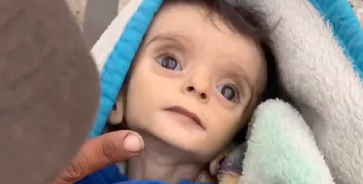 🕯️ This Little Baby Boy Was Starved to Death Today in Gaza
