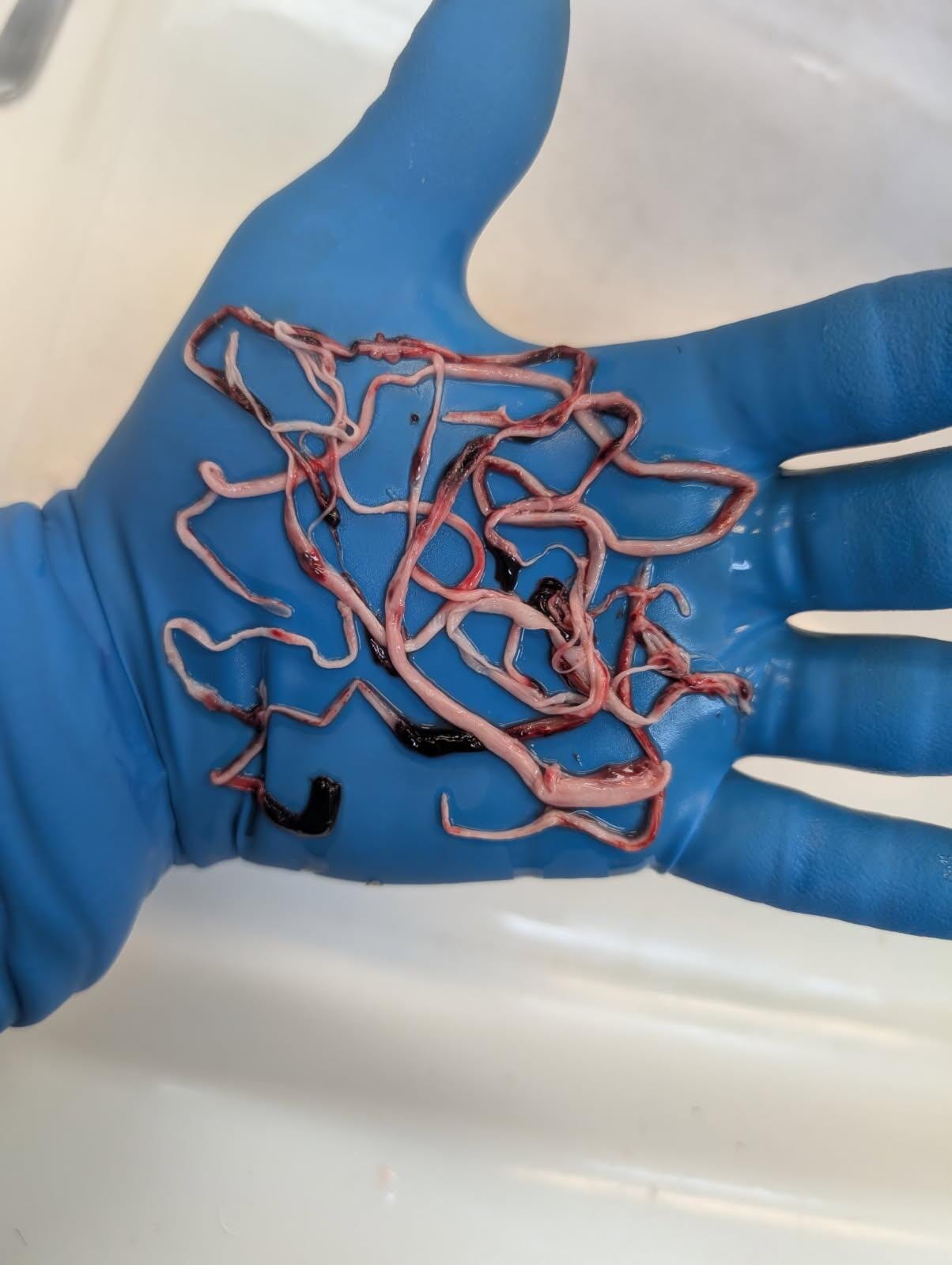 The Calamari Clots: Why the White Clots May Be the Smoking Gun of the ...