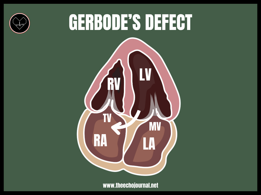 The Jet That Lied: How to Recognize a Gerbode’s Defect on Echo