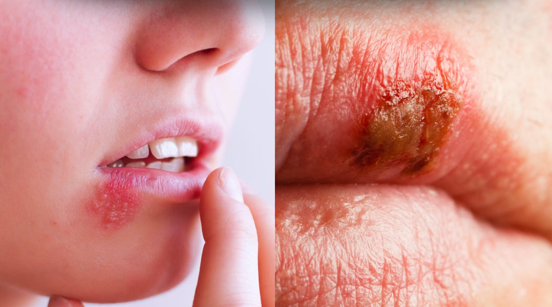 Herpes labial: o que é, sintomas, causas e tratamento