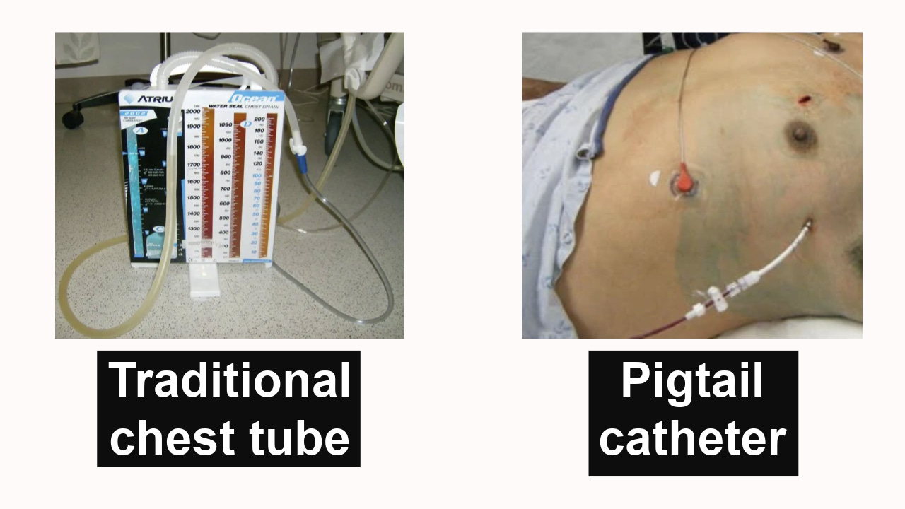 Chest Tubes & Pigtails: 5 Must-Know Tips for ICU Rotation