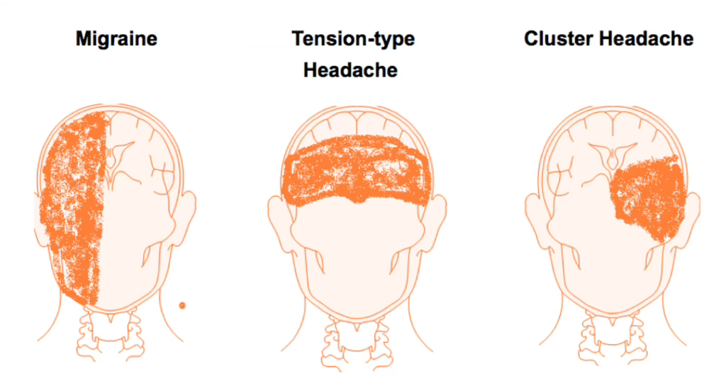 subparietal headache