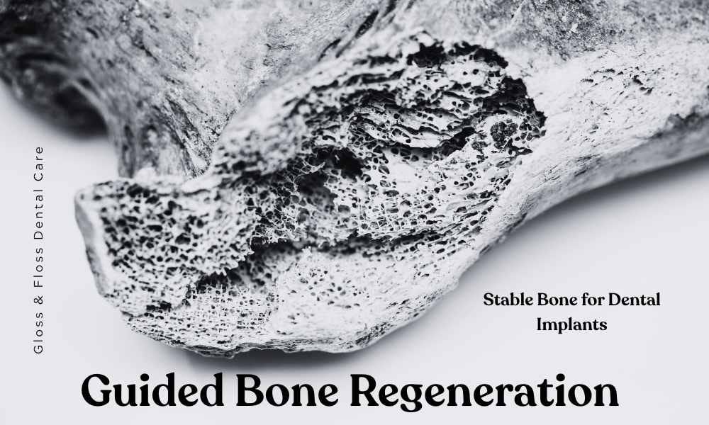 Guided Bone Regeneration in Stockholm – Insights for Patients