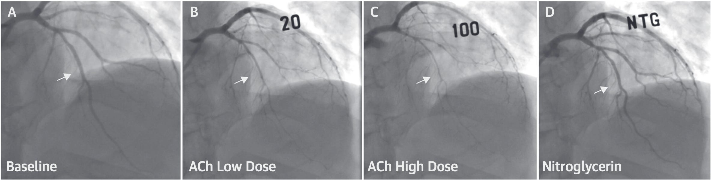 ANOCA - DozeNews - Cardiologia pela Doze por Oito