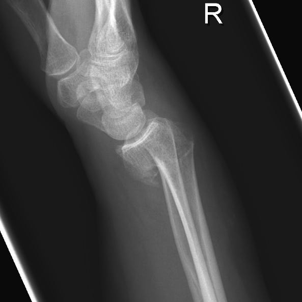 Distal radial fractures - by Alexander Baxter - RadNotes