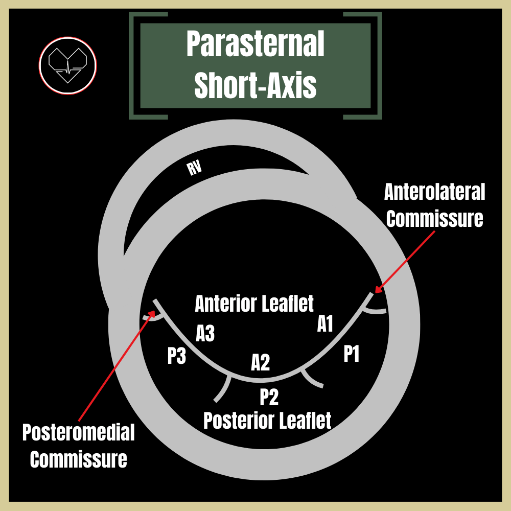 Mitral Valve: Beyond the Basics - by Alex C.