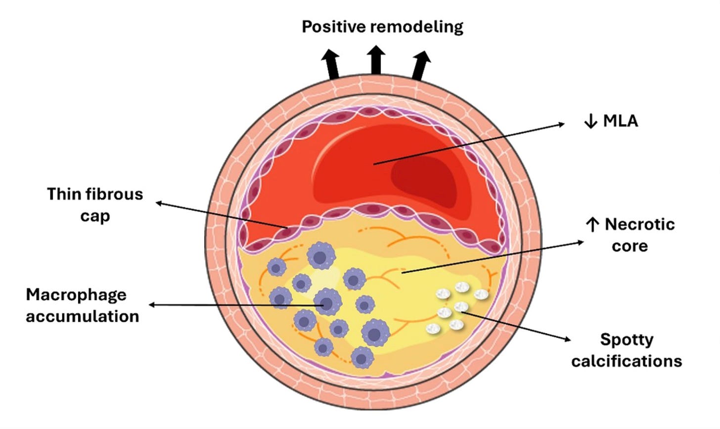 how do atheromas form