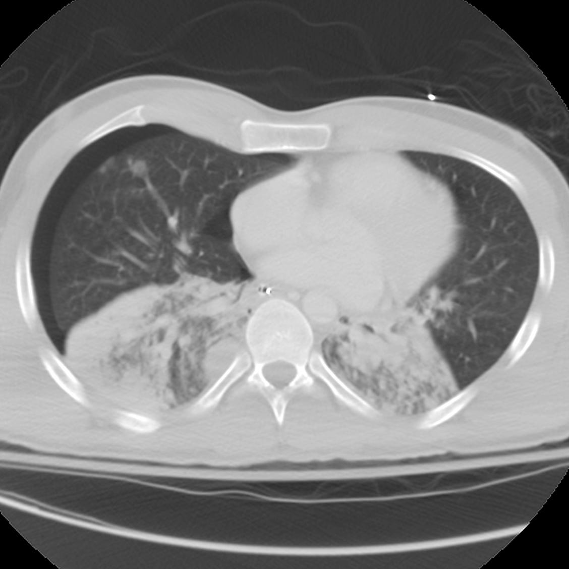 Pulmonary Contusions and Lacerations - by Alexander Baxter