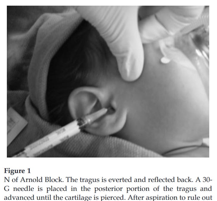 post auricular block
