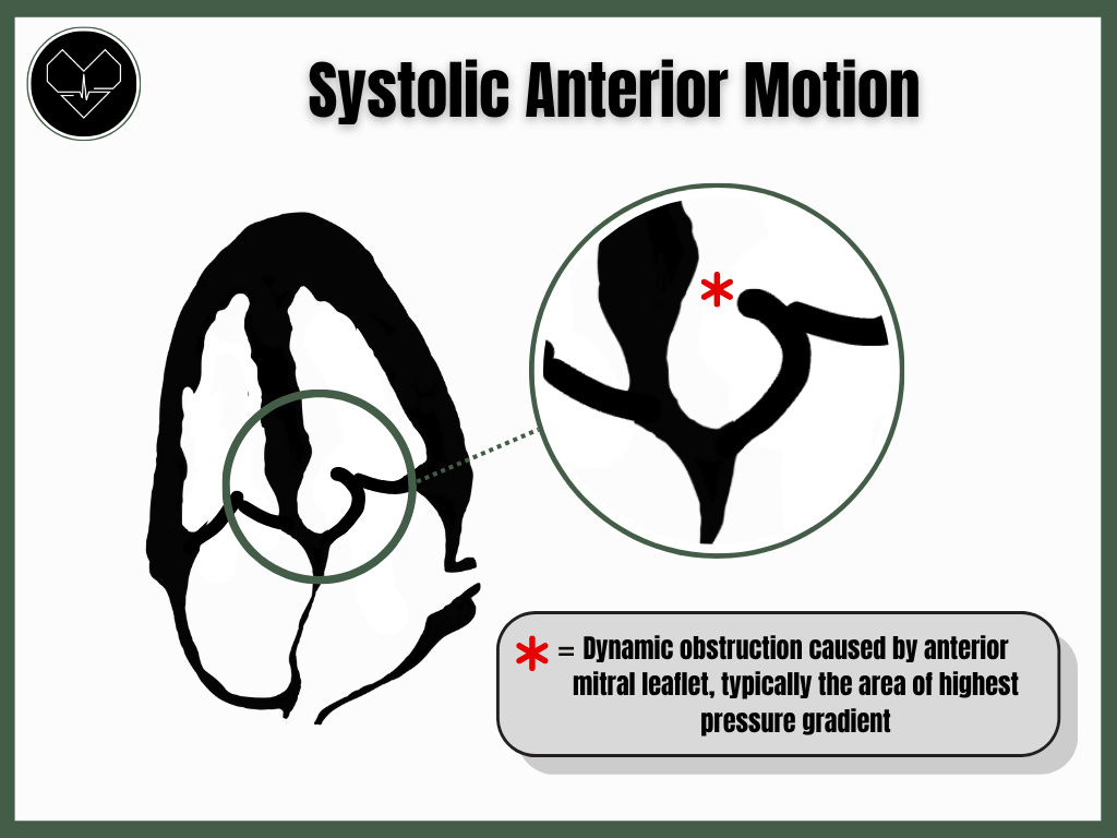 Understanding Systolic Anterior Motion (SAM)