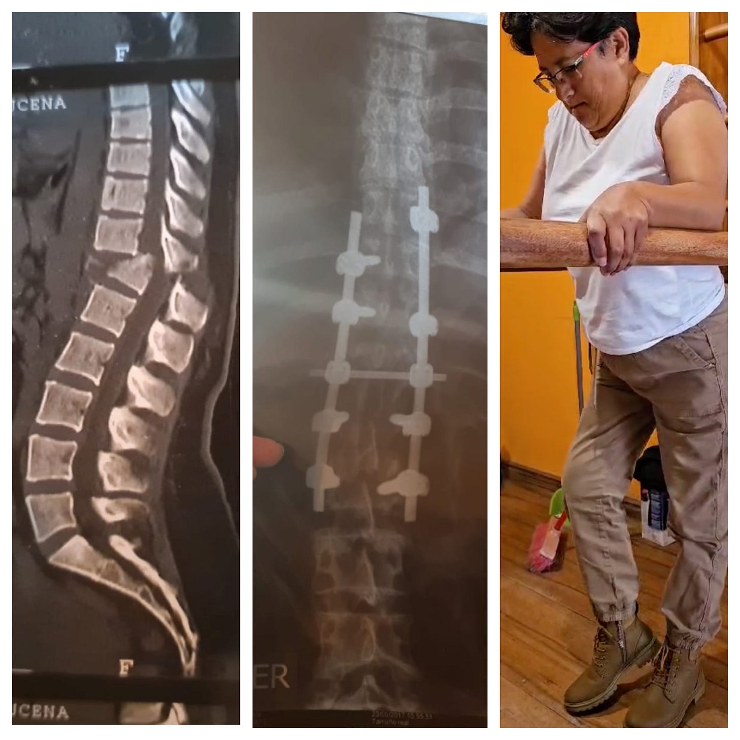 How DMSO Heals the Spine and Reverses Paralysis