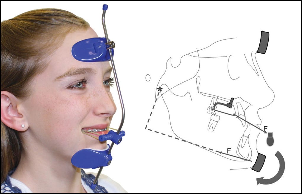 7.6 MARPE + Facemask for Protraction - by Ronald Ead