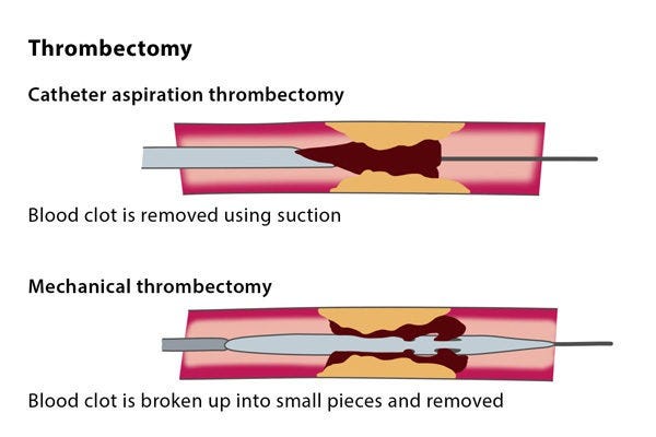 Boston Scientific Pays $14.5B for Penumbra: Inside Modern Thrombectomy