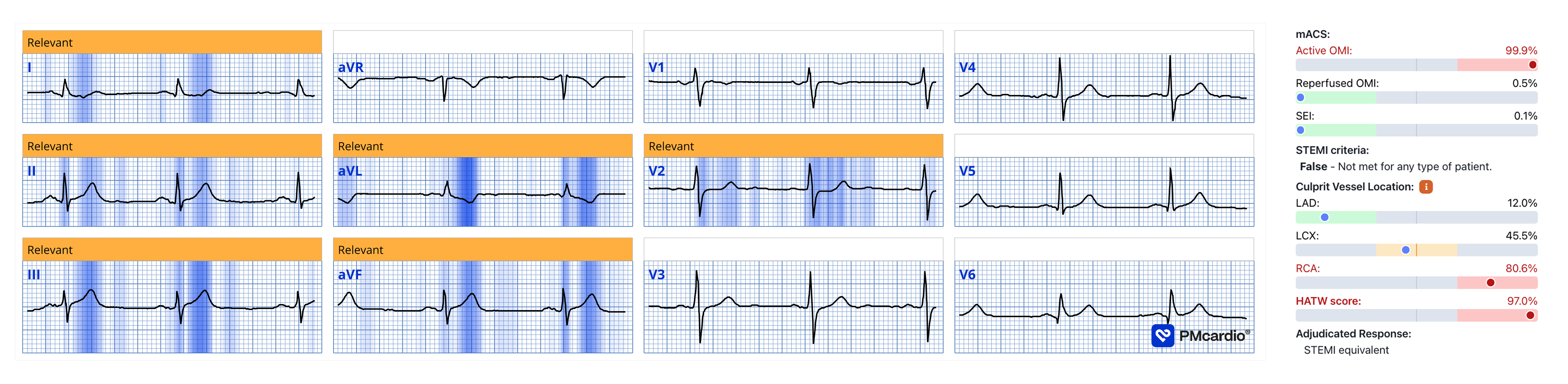 Inferior OMI ECG: Hyperacute T-Waves, Delayed Recognition, and ...