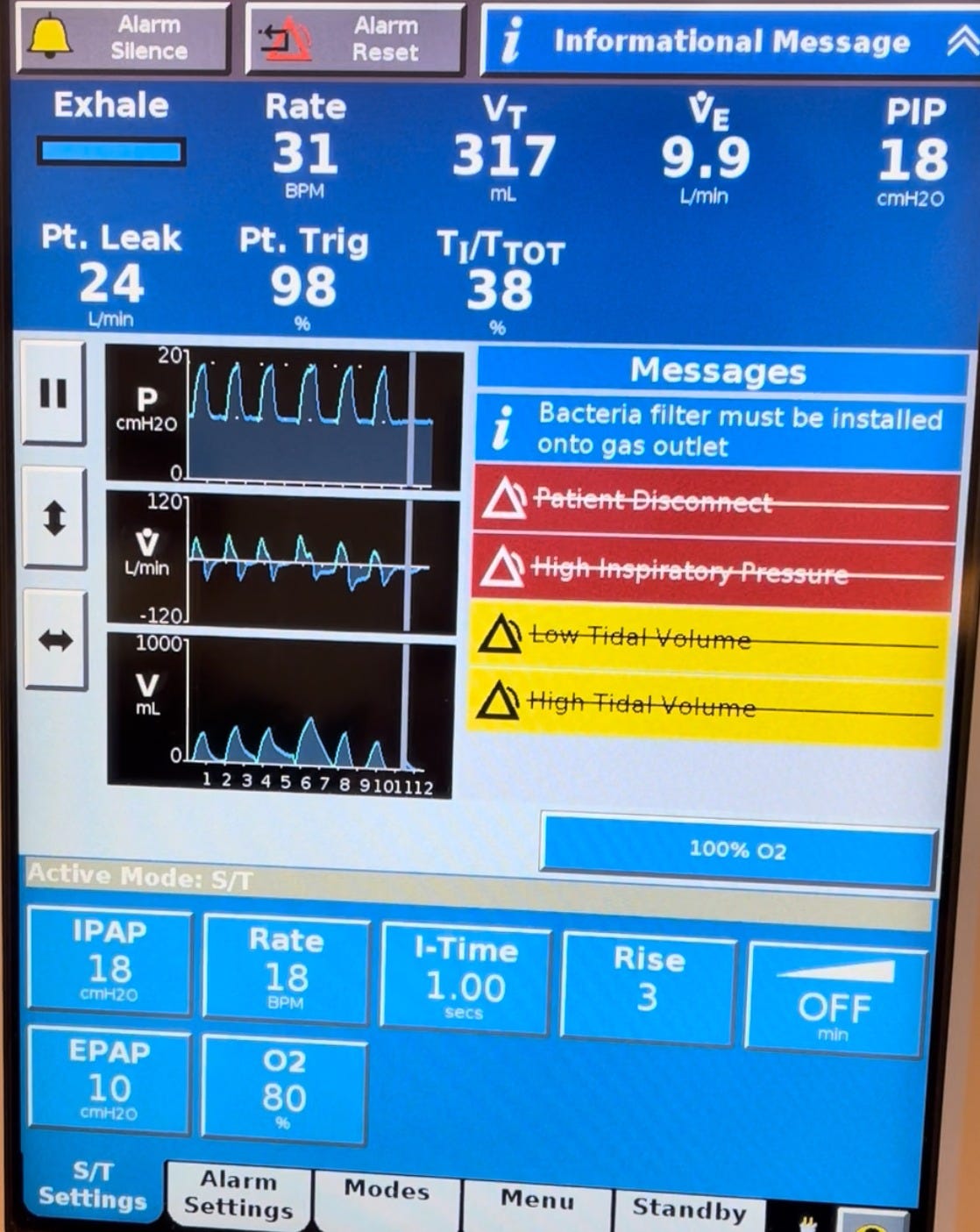 CPAP, BiPAP, AVAPS, HFNC – Which One Does Your Patient Need?