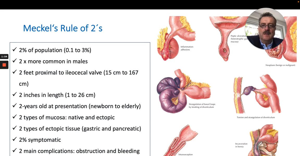 Meckel's Diverticulum: When the Rule of Twos Meets Real-World Endoscopy