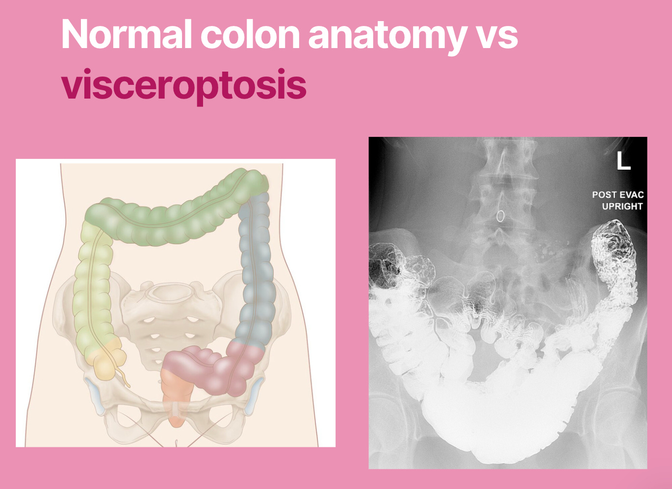 Visceroptosis and Hypermobile Ehlers-Danlos Syndrome