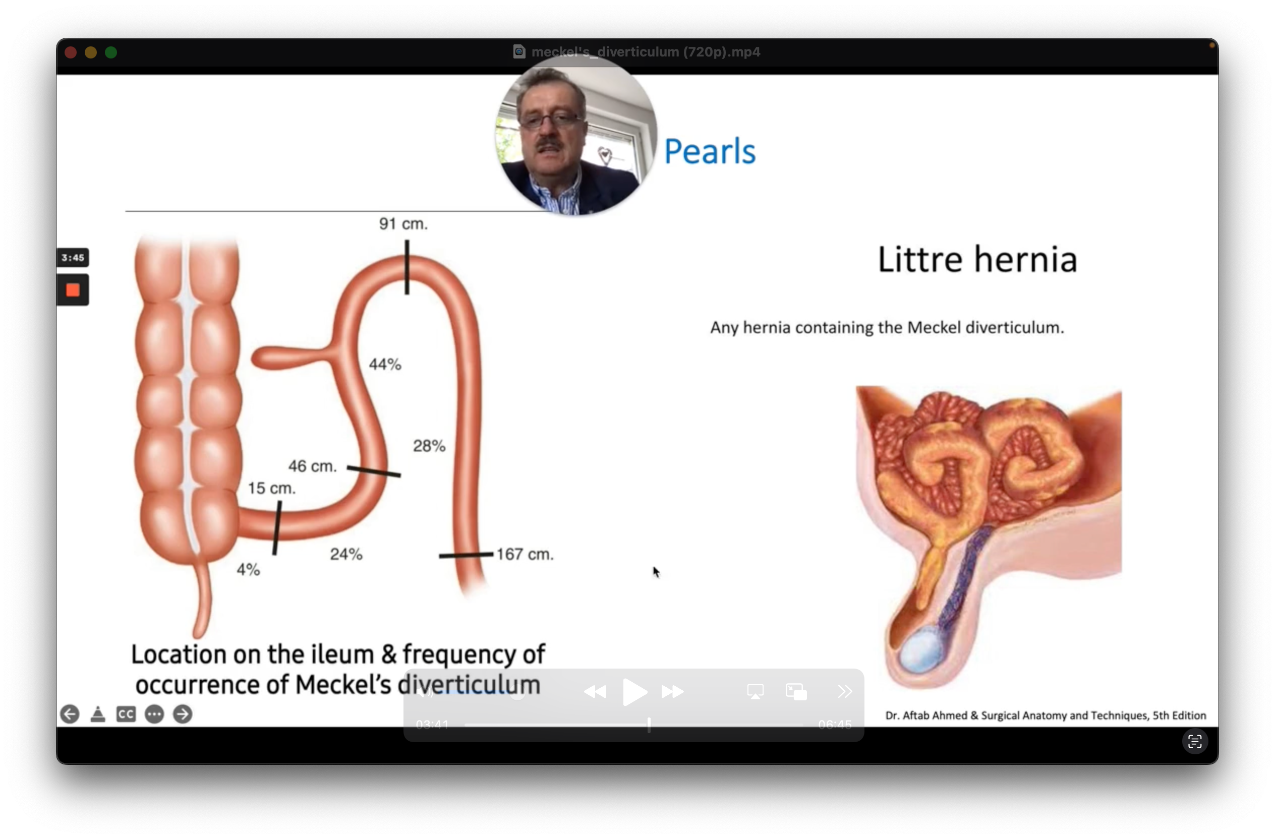 Meckel's Diverticulum: When the Rule of Twos Meets Real-World Endoscopy