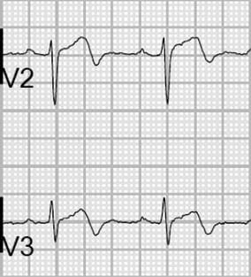 Discussão de ECG: Síndrome de Wellens