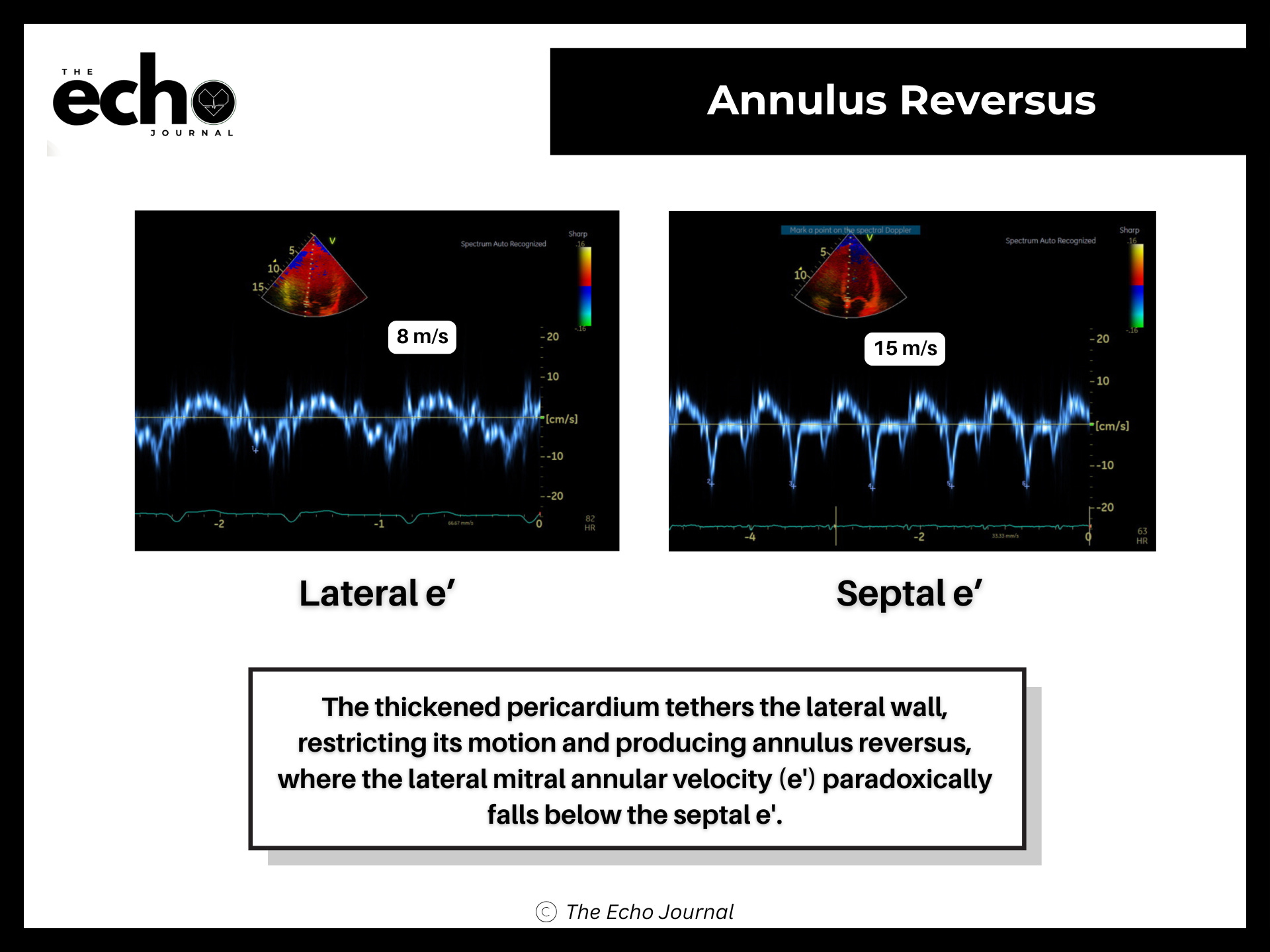 Constrictive Pericarditis: The Echo Findings You Can't Afford to Miss