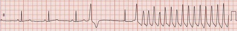 Longer is always better - ECG Teaching Cases