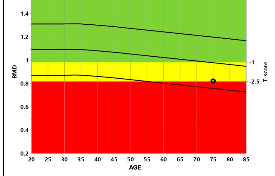 REMS Test for FUNCTIONAL Bone Health - A Better Evaluation than DXA and ...