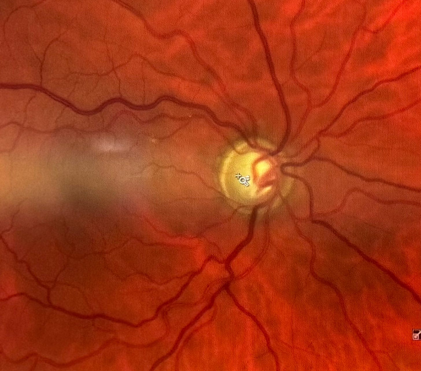 The Night My Husband Went Blind - Dr. Boz