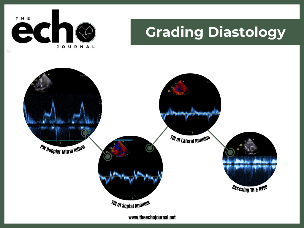Diastology Simplified - by Aram K. - The Echo Journal