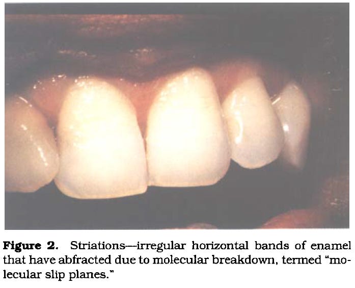 Abfractions: A New Classification of Hard Tissue Lesions of Teeth