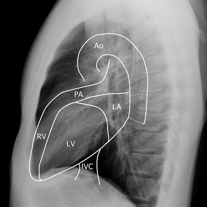 Chest anatomy - radiographs and CT - by Alexander Baxter
