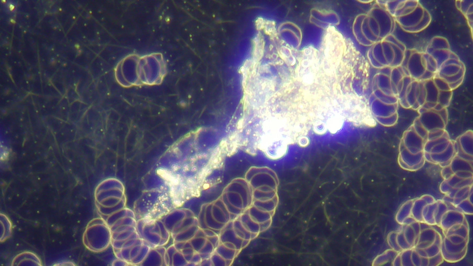 Blood under the Microscope before liposomal EDTA and Vitamin C