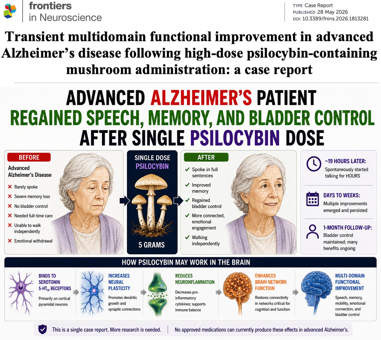 NEW STUDY: Advanced Alzheimer’s Patient Regained Speech, Memory, and ...
