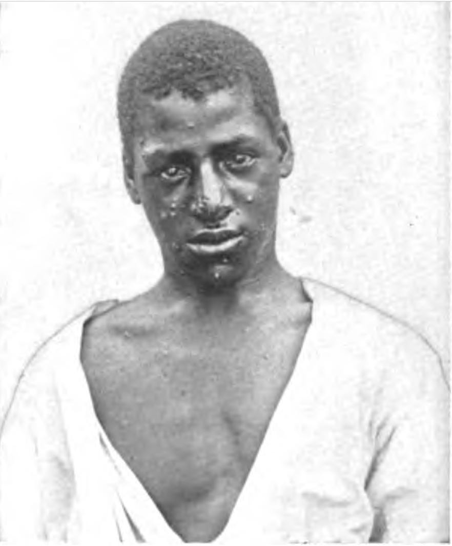 What if smallpox was a mild disease? - Roman Bystrianyk