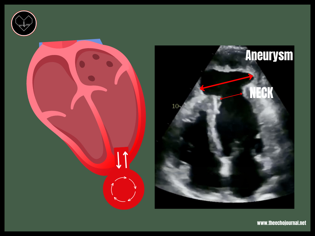 A Practical Guide to Recognizing and Managing Pseudoaneurysms Using ...