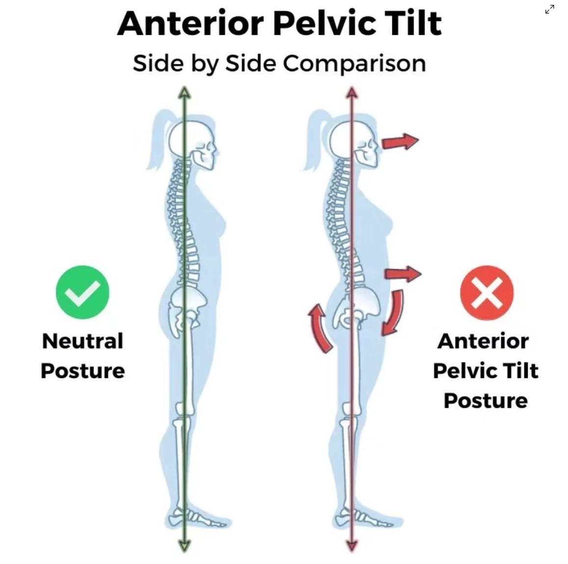 Your lower back won't stop arching - Fix Your Posture