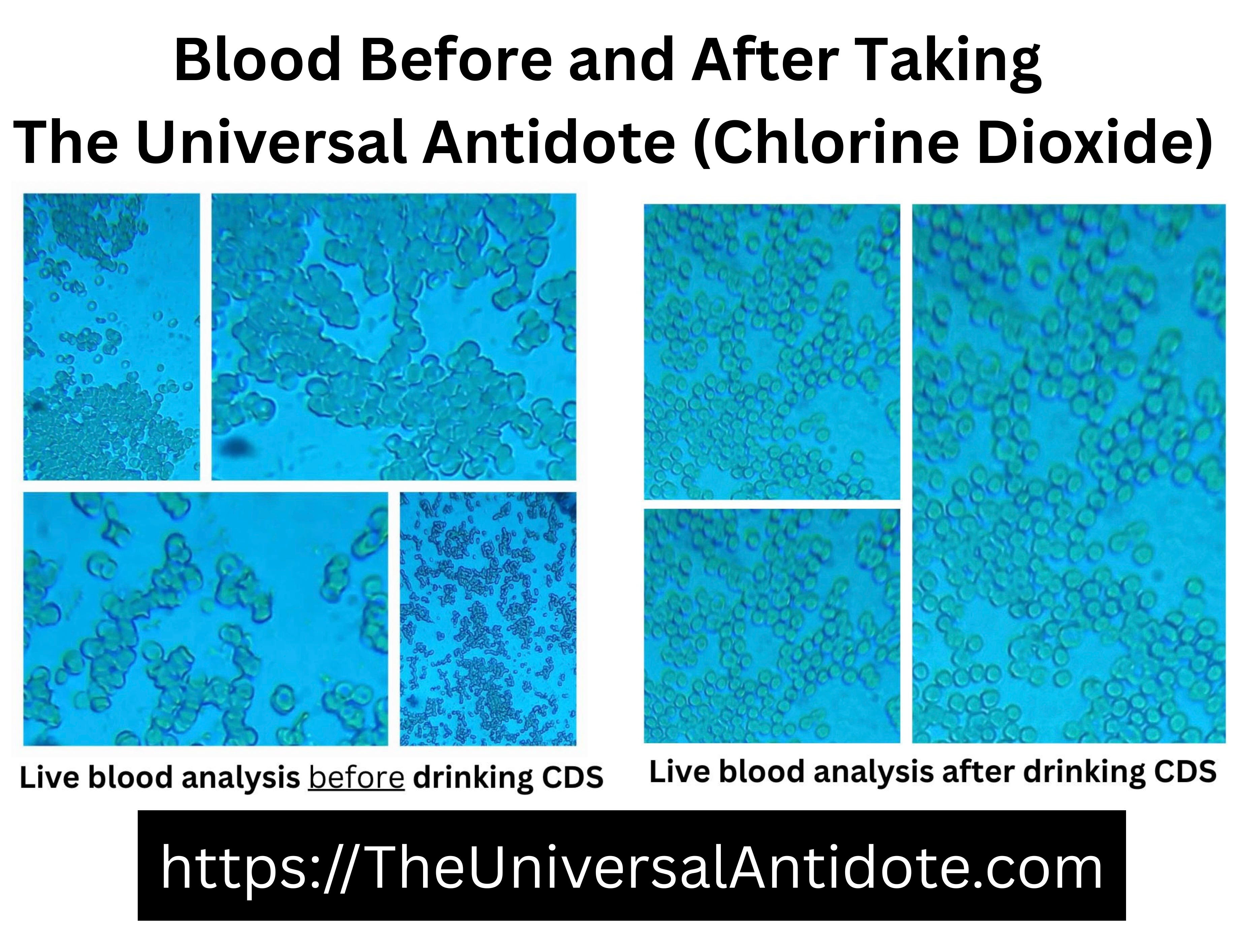 Live Blood Analysis and Chlorine Dioxide