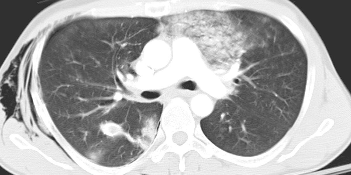 Pulmonary Contusions and Lacerations - by Alexander Baxter
